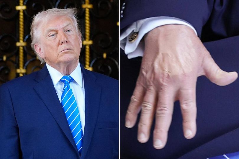 Trump's old excuse for hand bruising contradicted by latest development