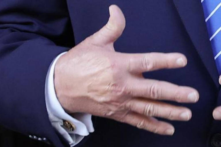 Trump's old excuse for hand bruising contradicted by latest development