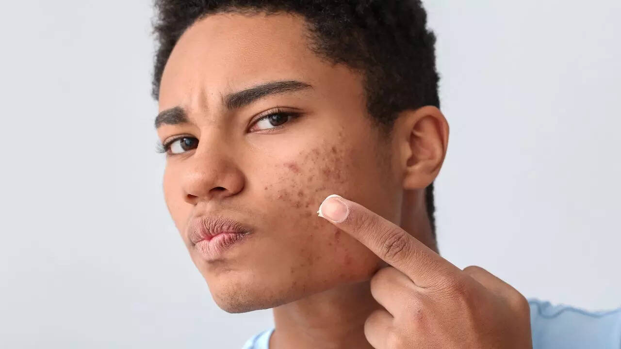 13 things that secretly trigger acne at home and cause breakouts ...