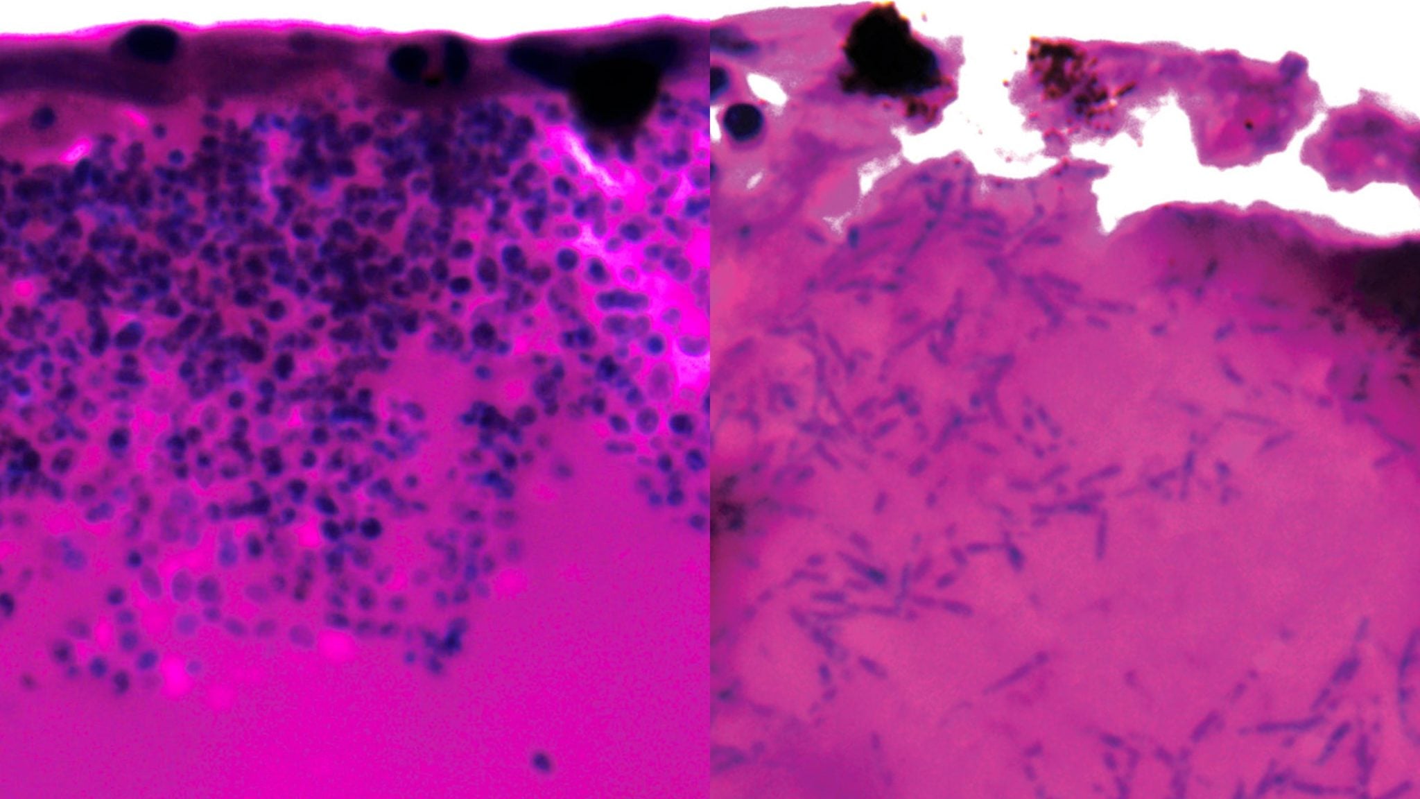 🔬 A weakness discovered in the invincible hospital fungus