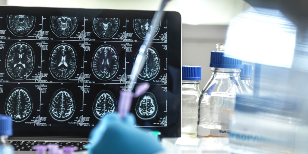 La maladie d’Alzheimer pourrait-elle bientôt être guérie ? Une avancée ...