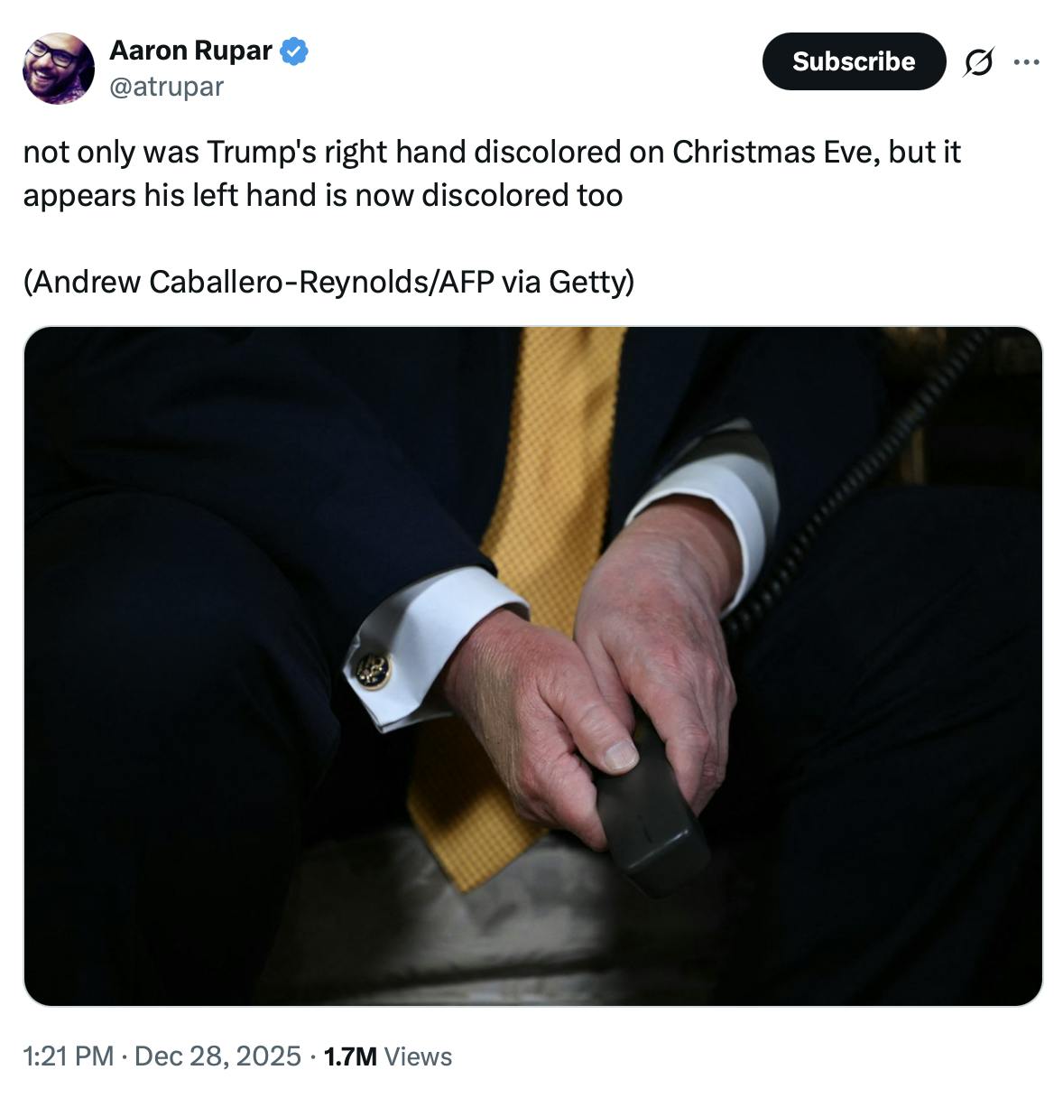 Trump, 79, now has weird bruises on both of his hands