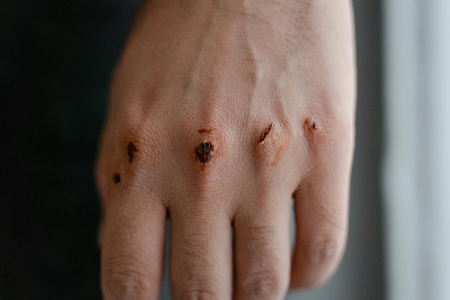 Why your skin forms scabs—and why picking them makes healing worse