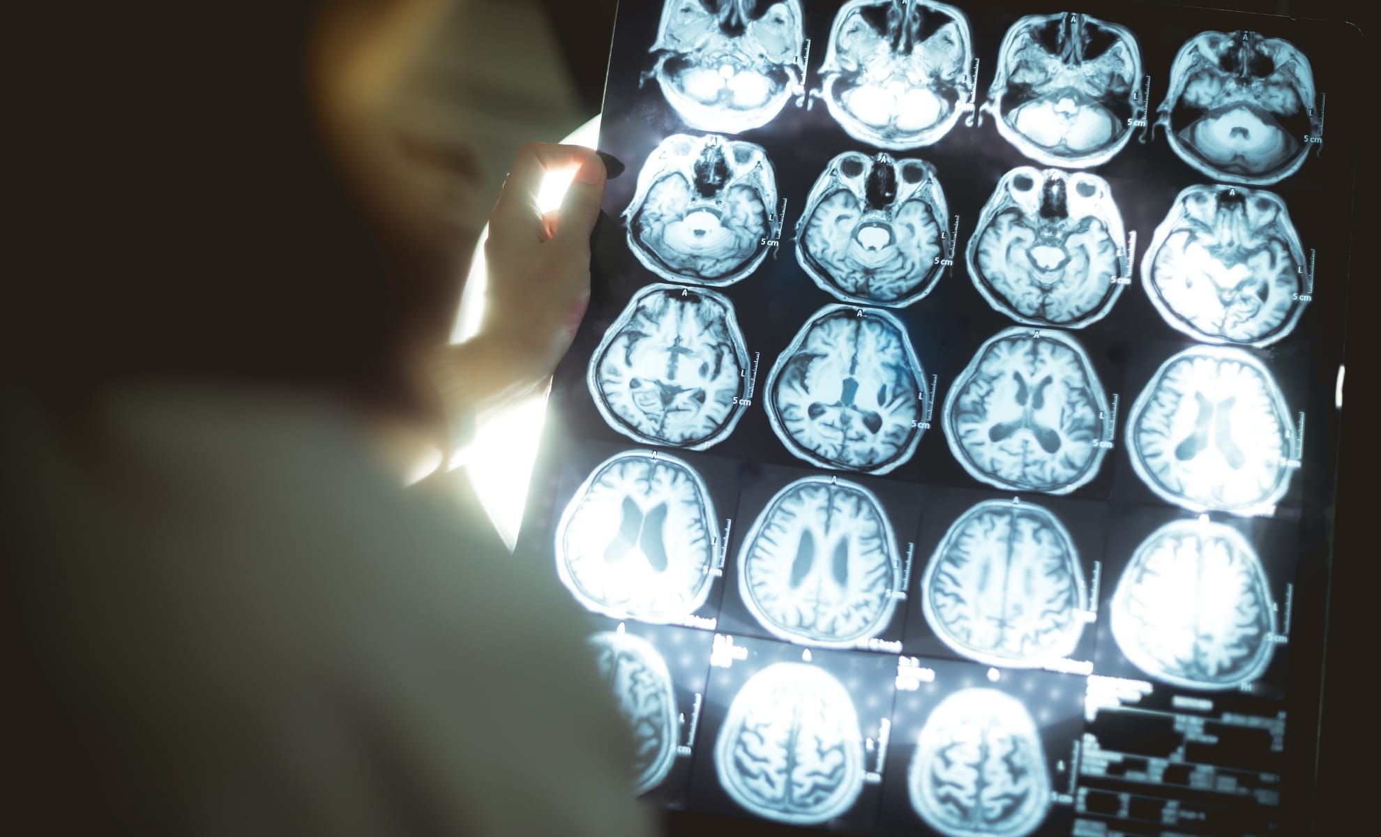 Scientists map hidden DNA switches in brain cells tied to Alzheimer’s ...