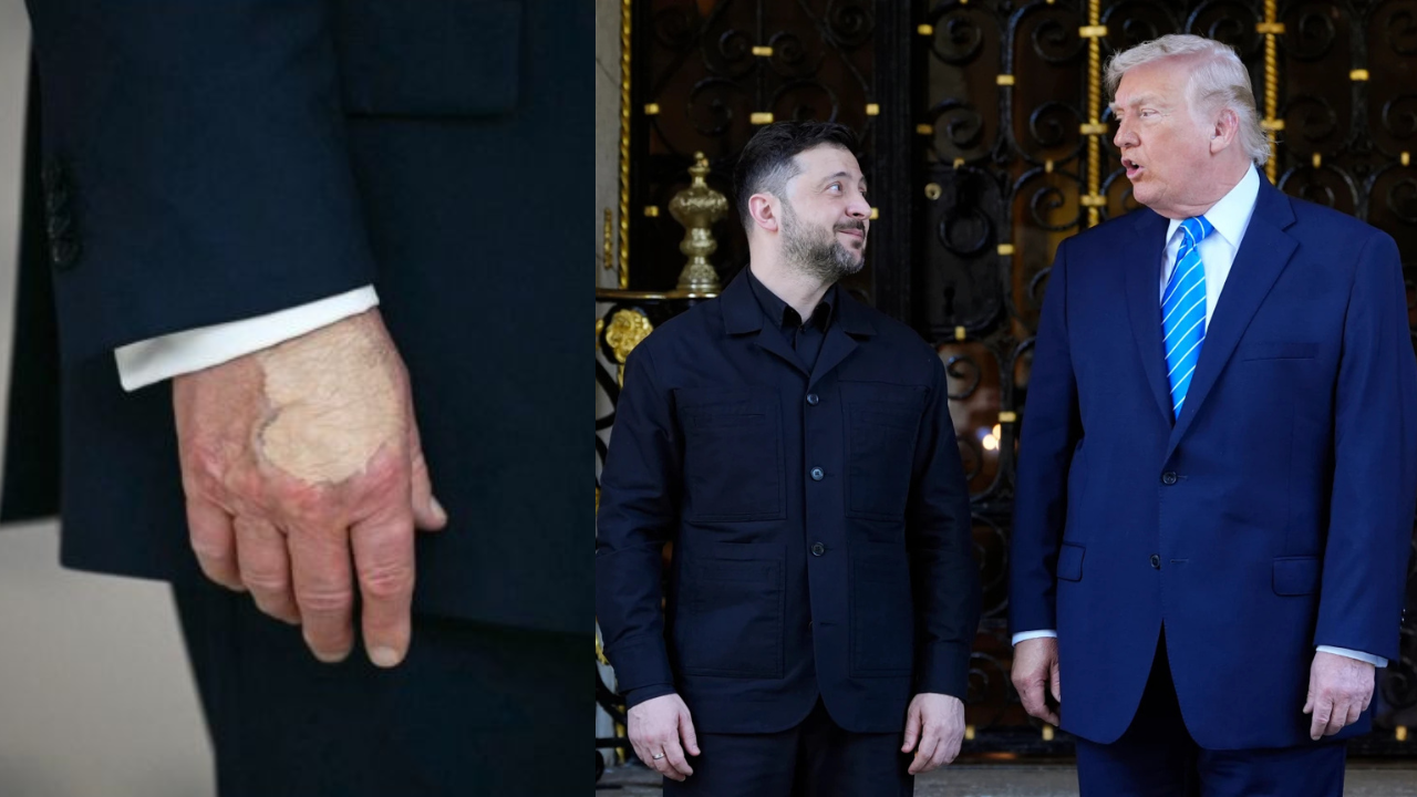 Concealer or IV bruises? Donald Trump's 'painted hands' set social ...