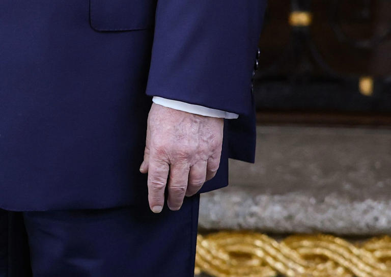 Trump’s hand bruise is on the move