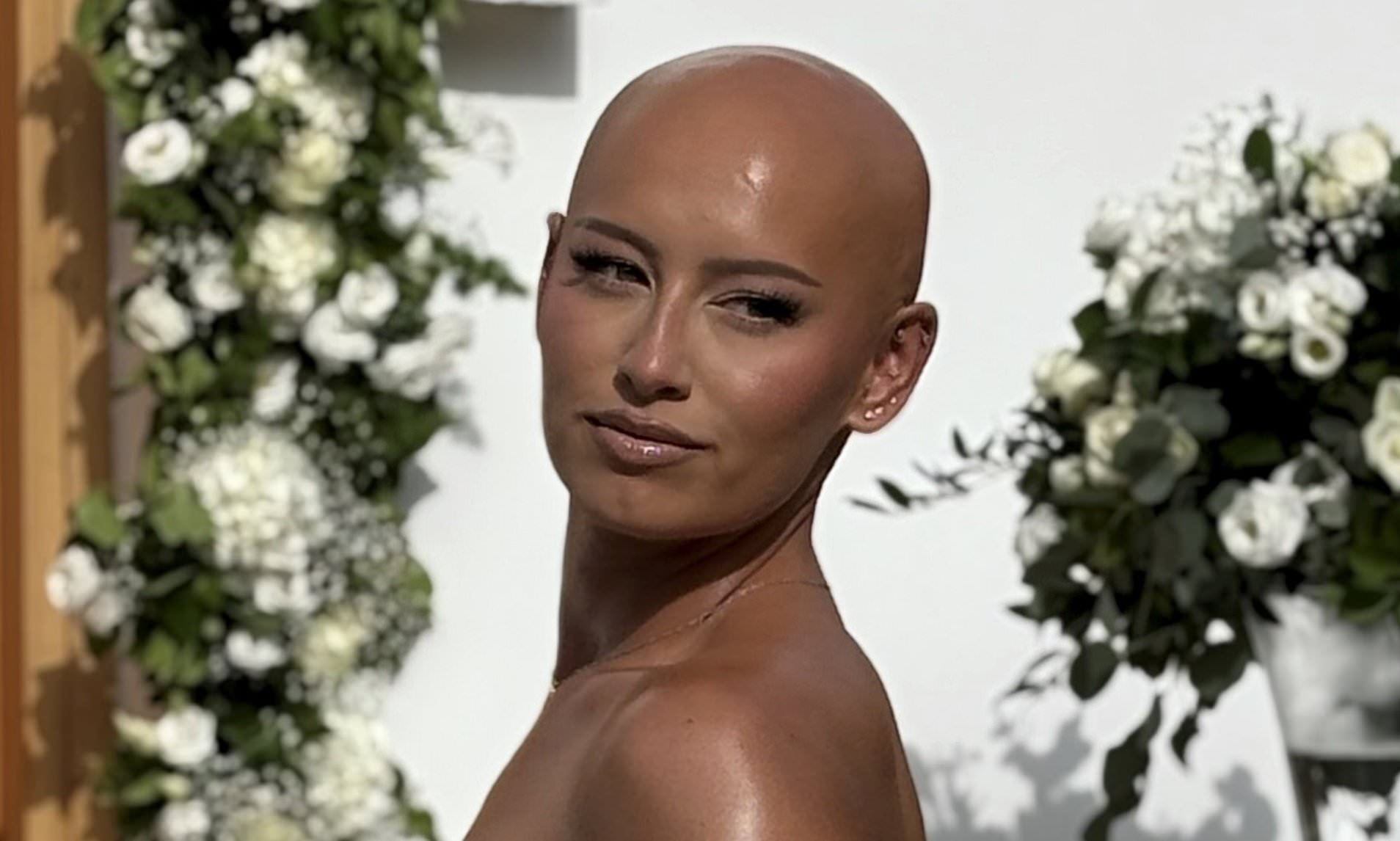 Bald bride with alopecia shows off her bare scalp for the first time on ...