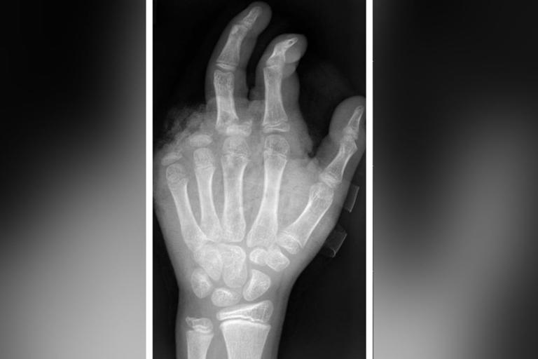 Abgetrennte Finger und Amputationen: So erlebt eine Handchirurgin die ...