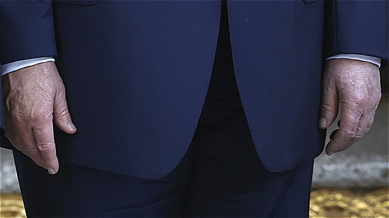 Up-close photos of Donald Trump's bruised hand look grisly