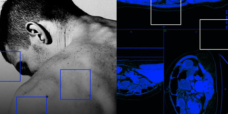 What causes early-onset colon cancer? New research offers clues