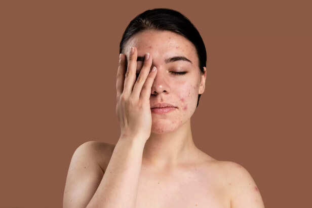 January acne vs hormonal acne: How to tell the difference