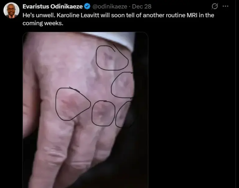 ‘What is he hiding?’: Official photo of Trump’s bruised hand Karoline ...