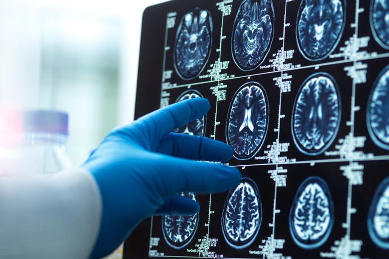 Researchers find link between the way you brush your teeth and dementia