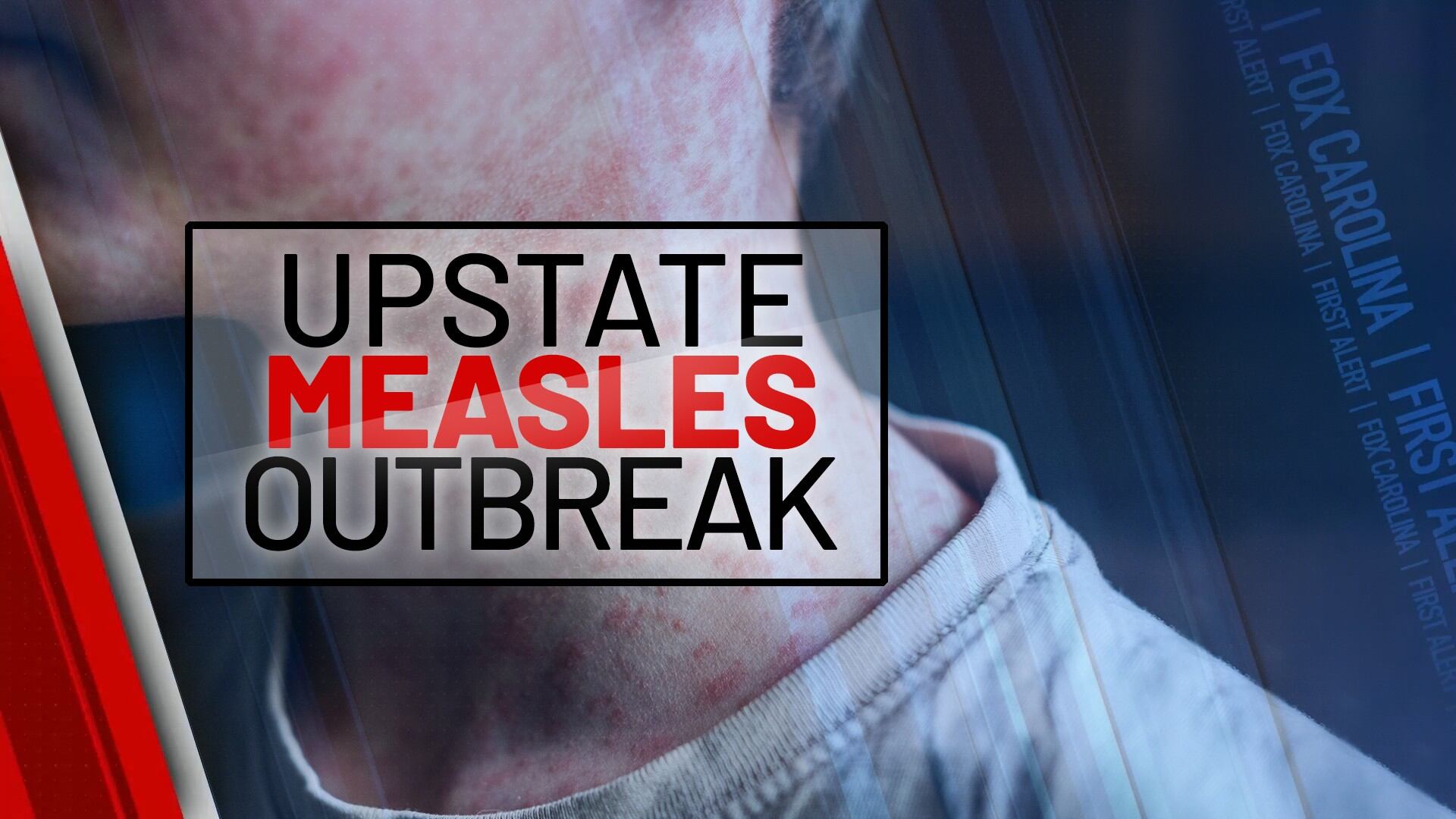 Live: Officials share latest update in Upstate measles outbreak