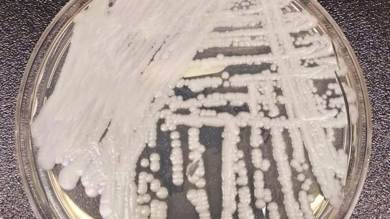 Superbug hits 27 states, including Louisiana: Here’s where the deadly ...