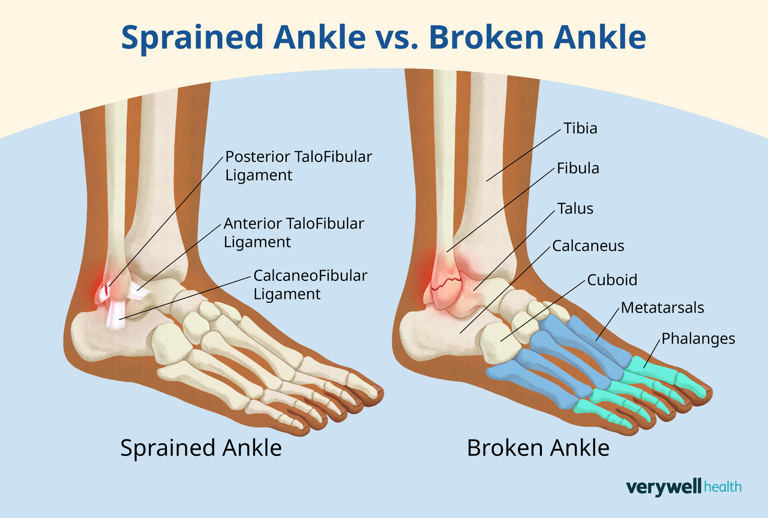 Signs of a sprained ankle vs. broken ankle and treatment options