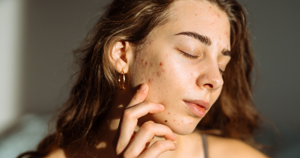 Acné après 25 ans : 1 femme sur 10 concernée, comment s’en débarrasser