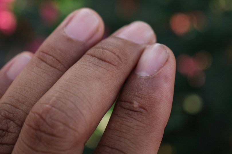 Early red flag of lung cancer may be identified by simple fingernail test