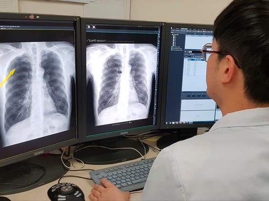Chest X-ray Screening Age to 50