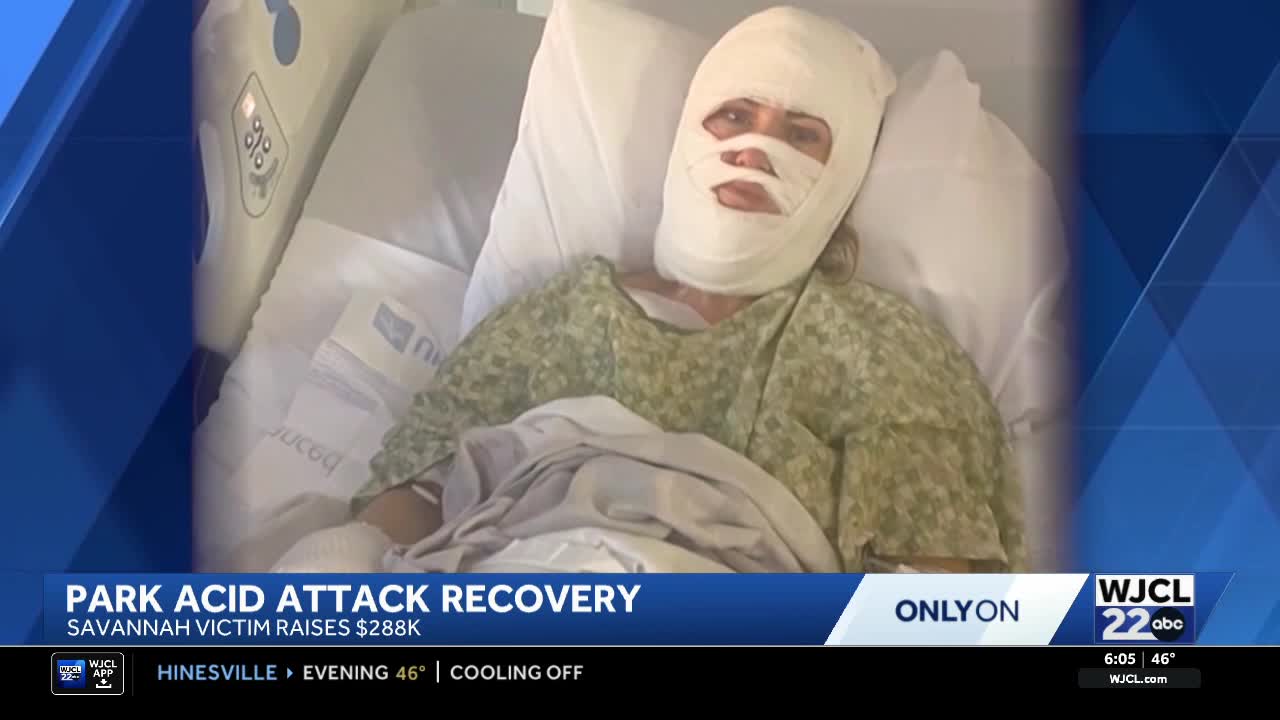Woman hurt in Savannah acid attack discharged from burn center; long ...