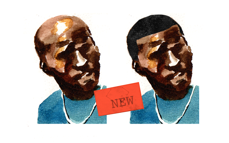 The real-deal truth about hair loss