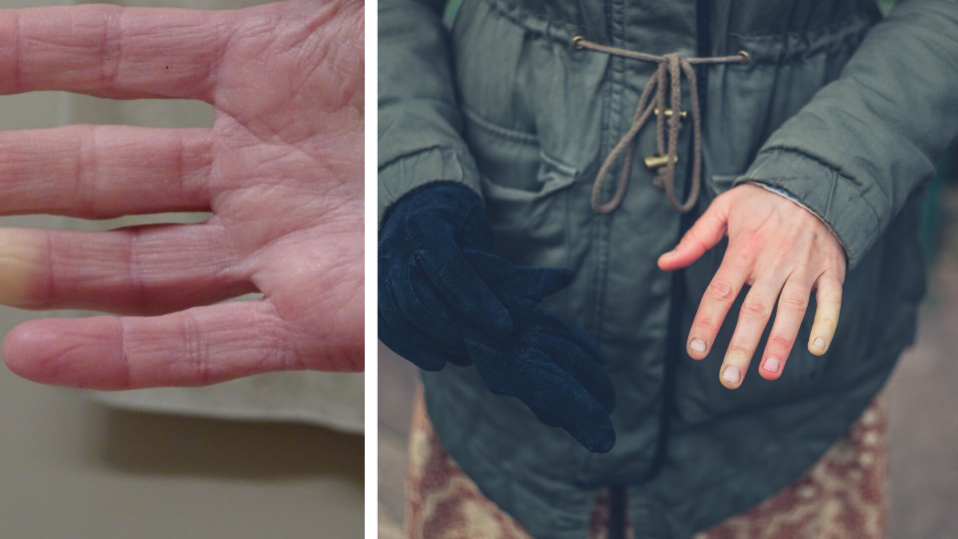 Snel last van witte vingers of witte tenen in de winter, hoe komt dit?