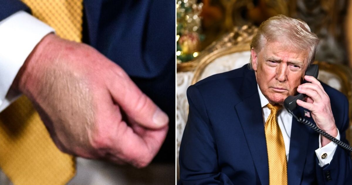 Trump sparks renewed health concerns with fresh bruises on left hand ...