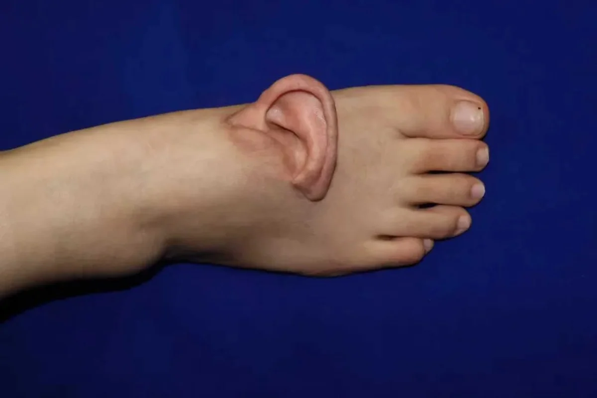 Scientists graft human ear onto foot