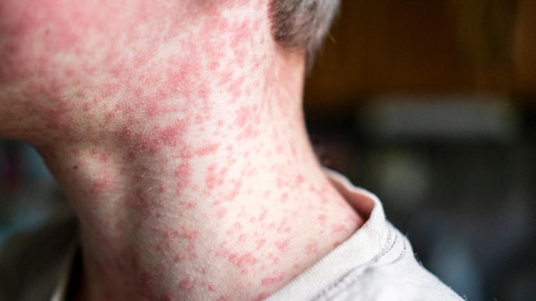 More than 2,000 measles cases reported in the US this year as ongoing ...