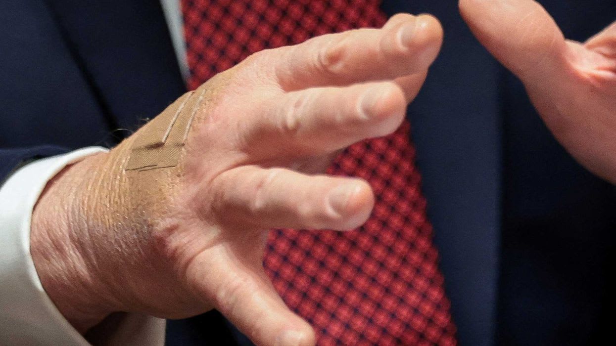 Mystery bruises fuel new health questions for 79-year-old Trump
