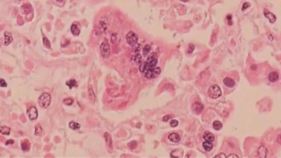 Measles exposure alert issued for Northern Kentucky after Ark Encounter ...