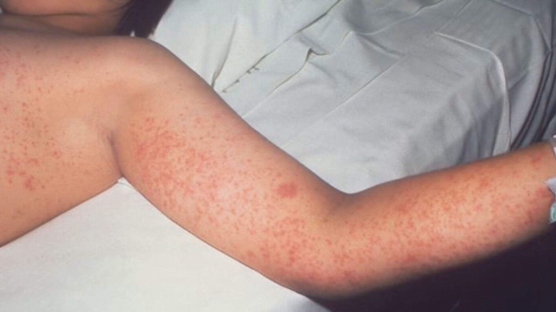 Possible measles exposure at NKY hotel, attraction