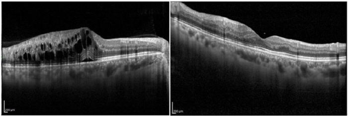Patients with sudden vision loss, retinal vascular obstruction ...
