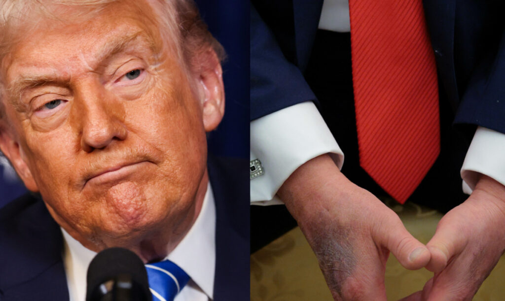 Donald Trump blames hand bruises on aspirin; brushes off health ...