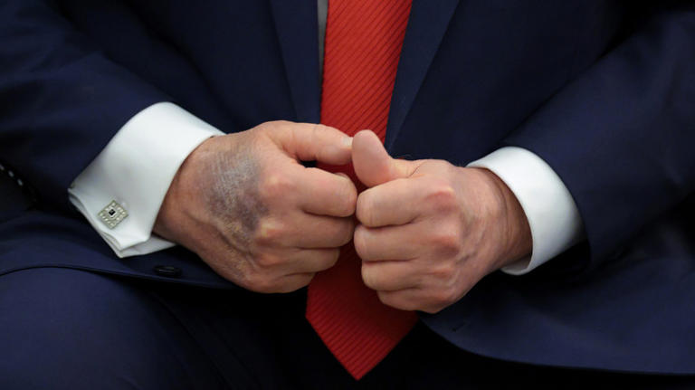 Donald Trump's suspicious hand bruising spreads & raises even more ...