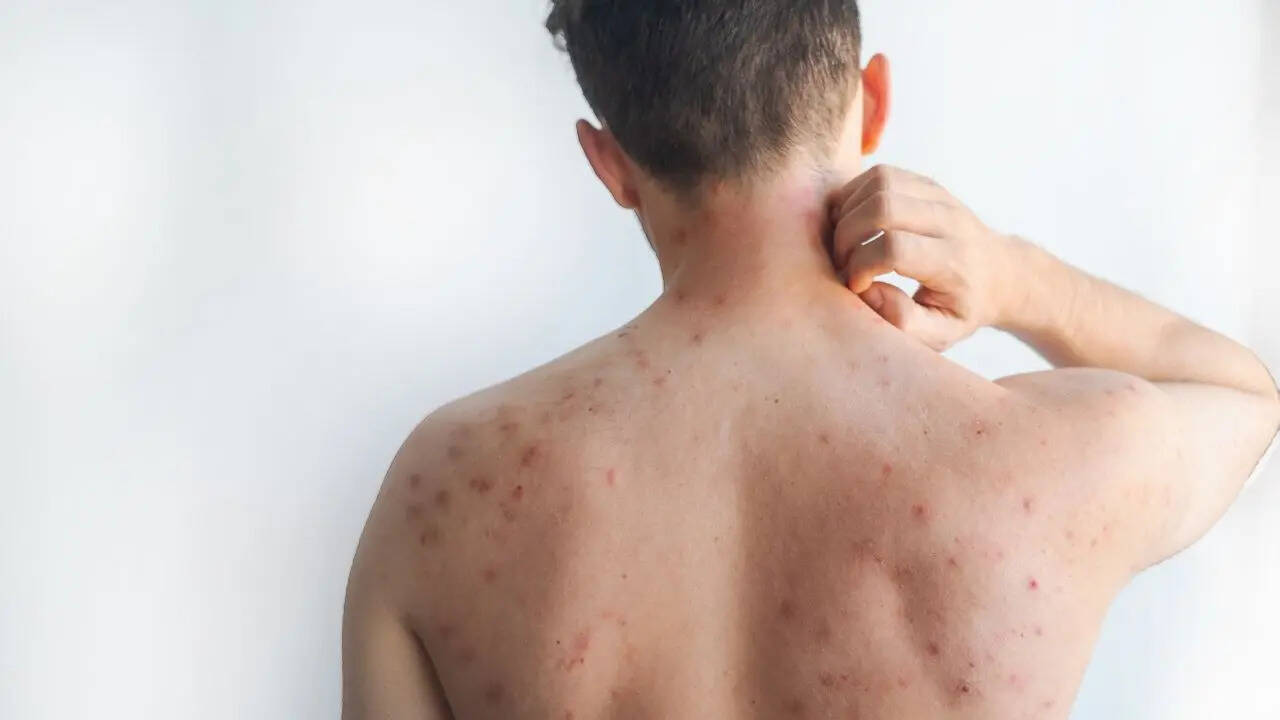 US measles cases surge past 2,000, putting elimination status at risk