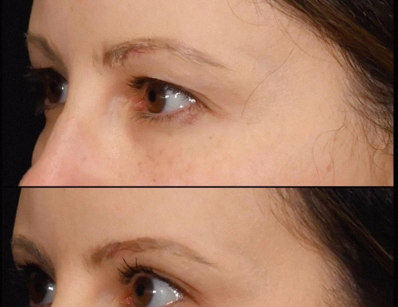 An eyelid lift in your 30s? Why younger women are getting ‘blephs’