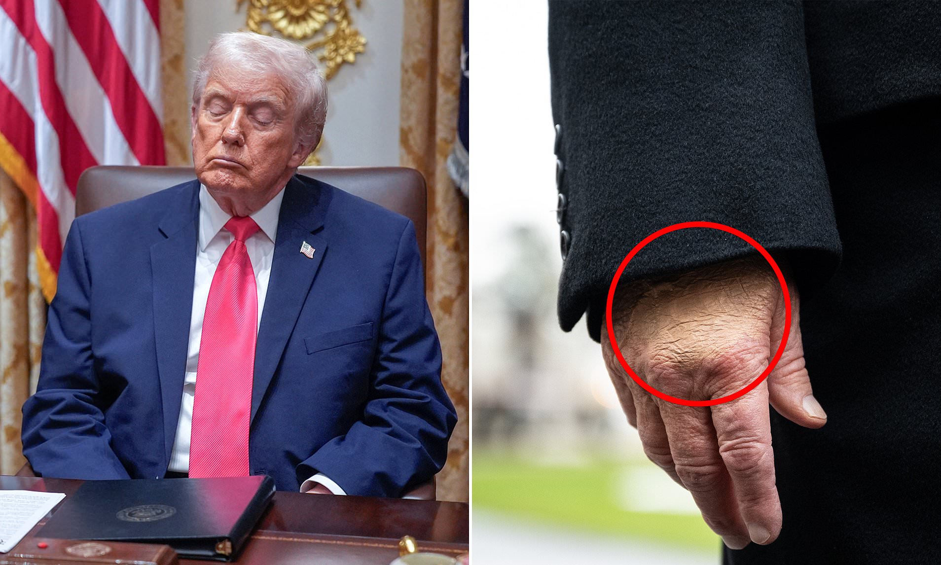 Blood, bruises and sleepless nights: Trump makes health confession as ...