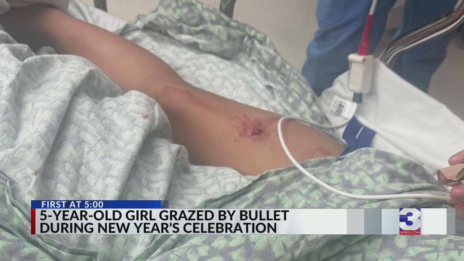 5-year-old grazed by bullet on New Year's Eve