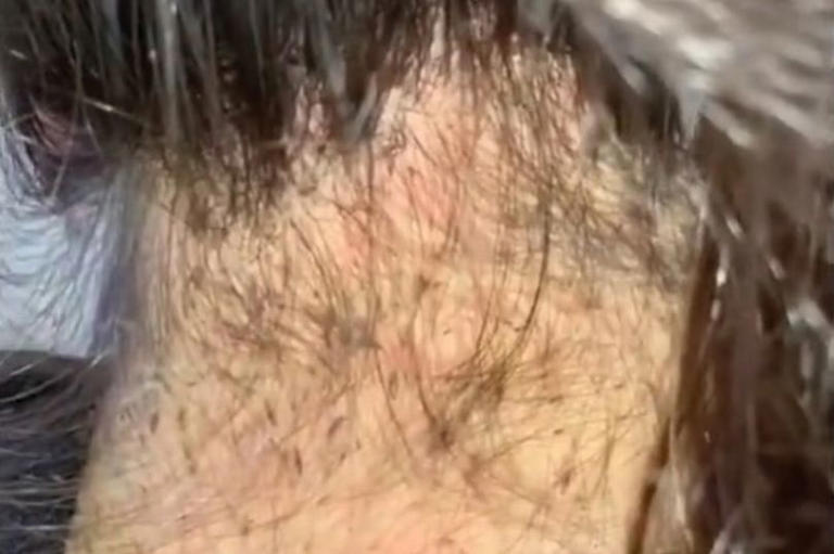 Nit remover forced to shave client’s head after finding infestation of ...