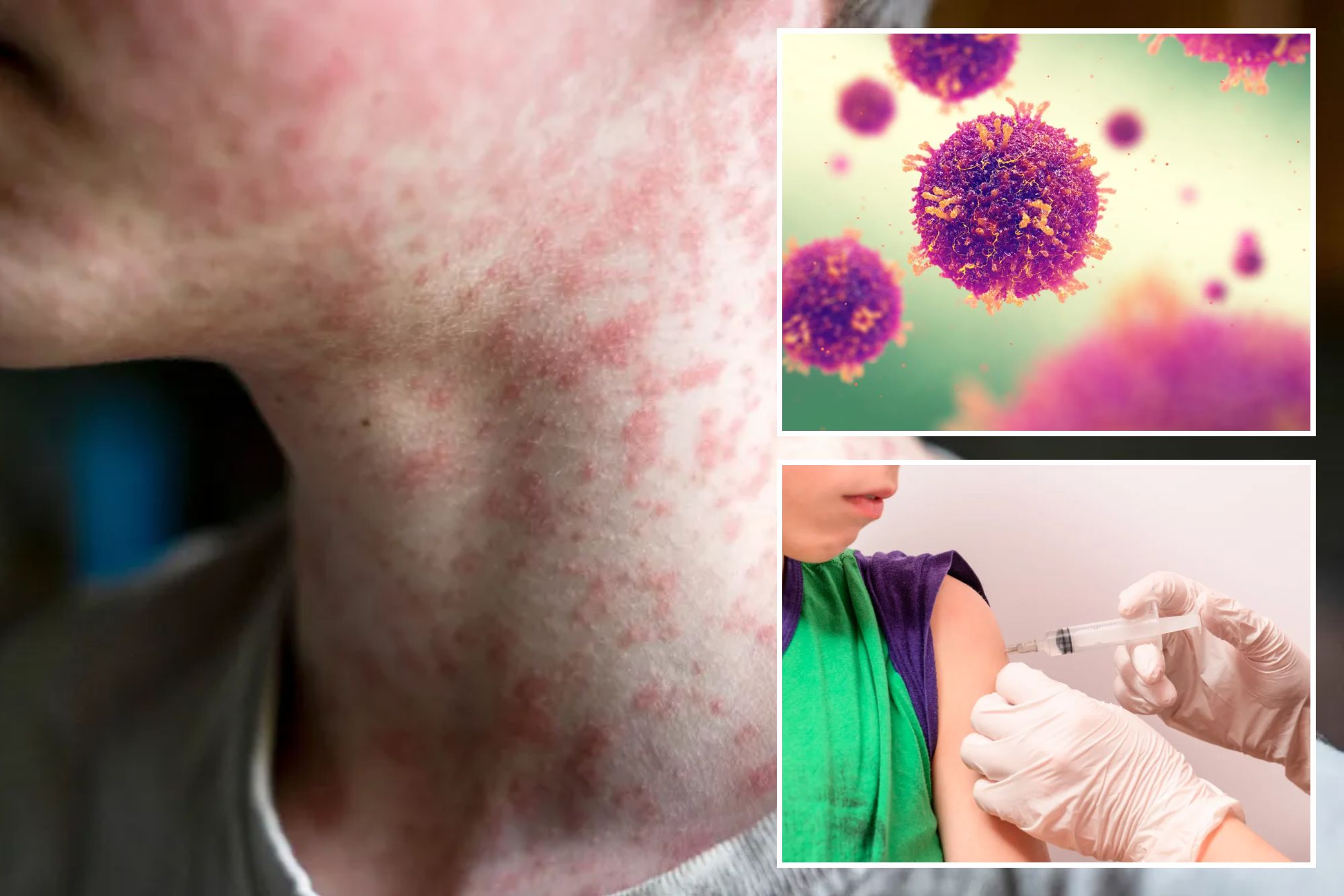 The scary measles complication that makes your body forget how to fight ...