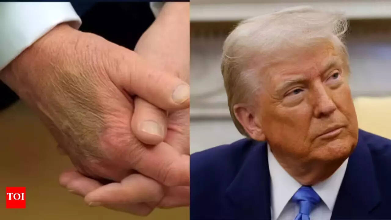 Compression socks, aspirin and makeup: Trump admits concealing visible ...