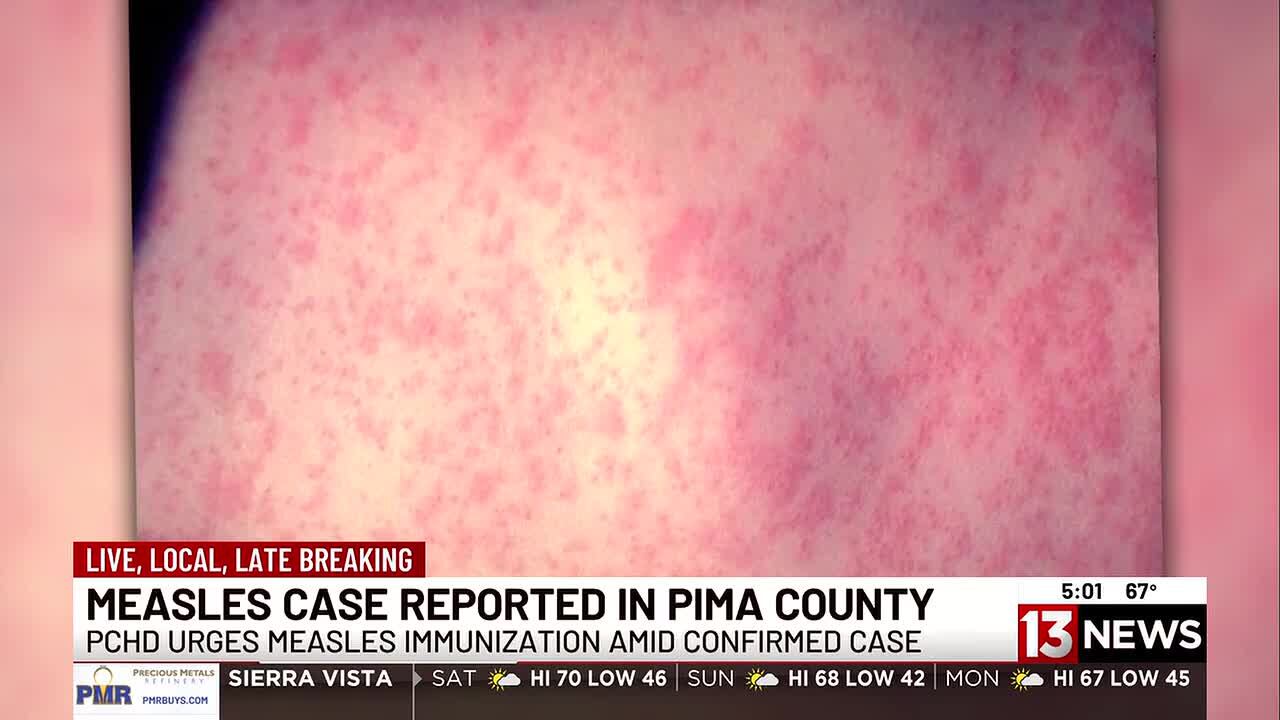Pima County reports first measles case since 2019