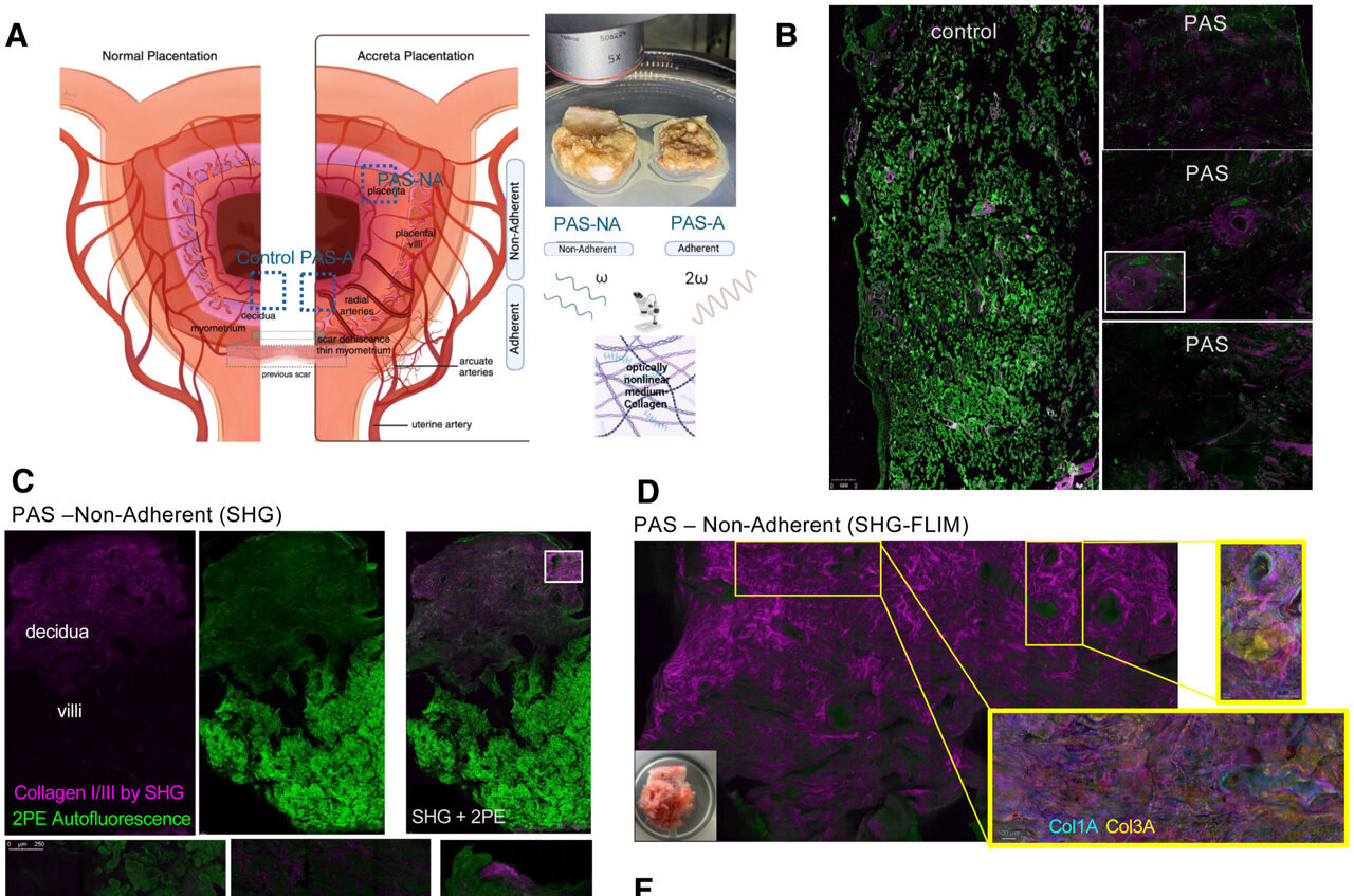 Tangled scar tissue may set stage for dangerous placenta condition