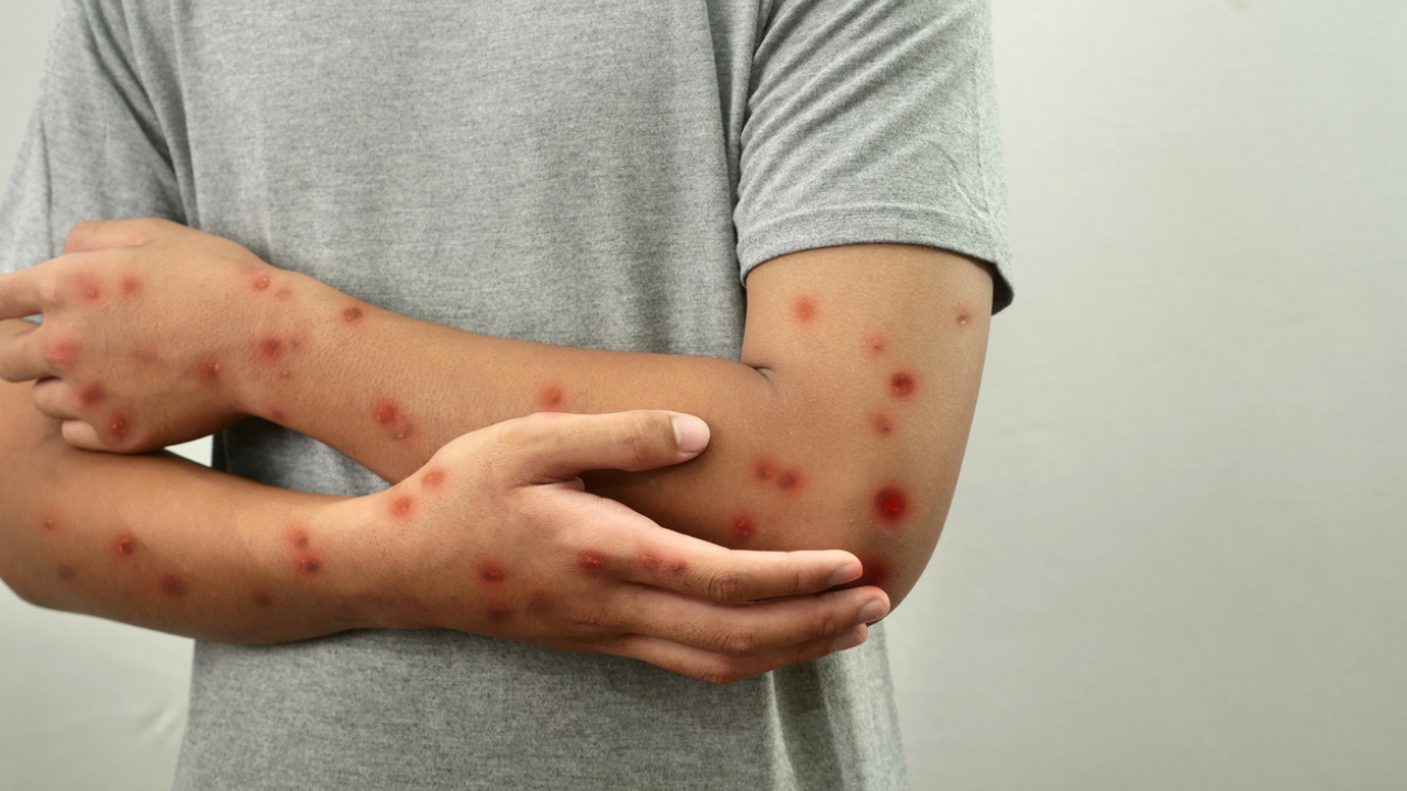 Chickenpox vaccines for children on NHS start across UK, here's what ...