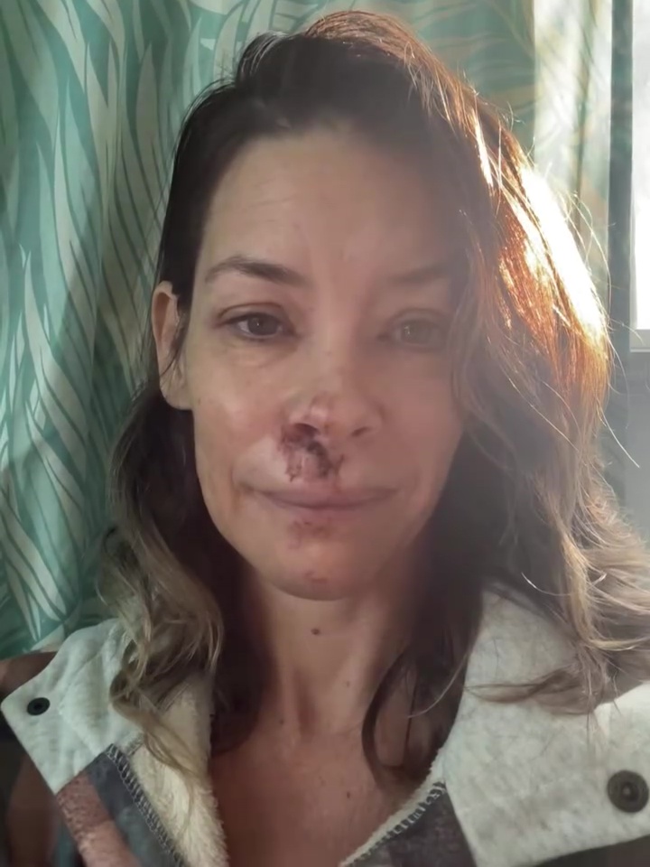Evangeline Lilly shares devastating brain injury months after falling ...