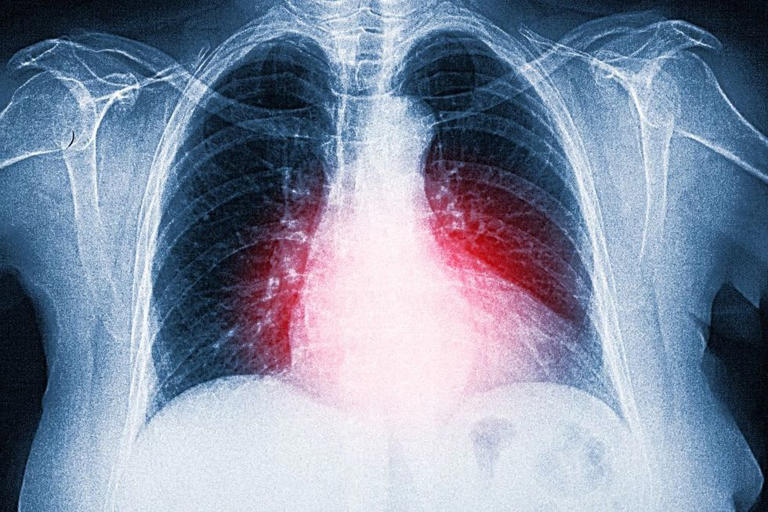 Heart attack: Nurse breaks down 2 simple lifestyle tweaks to slash your ...