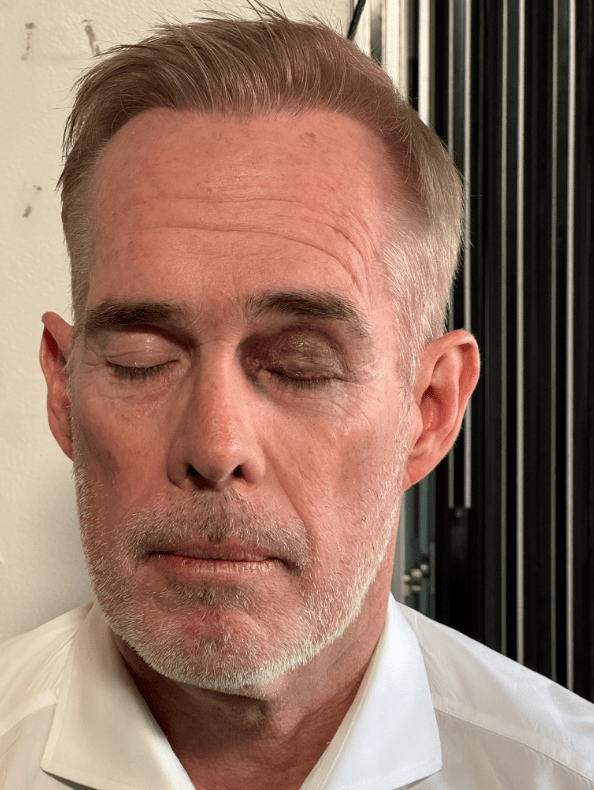 Joe Buck reveals black eye hidden by ESPN makeup artist after Seahawks ...