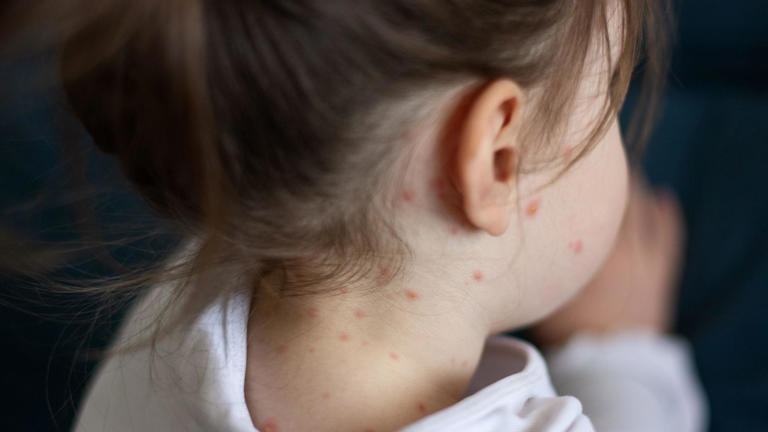 'My parents didn't know if I was going to live' - chickenpox vaccine ...