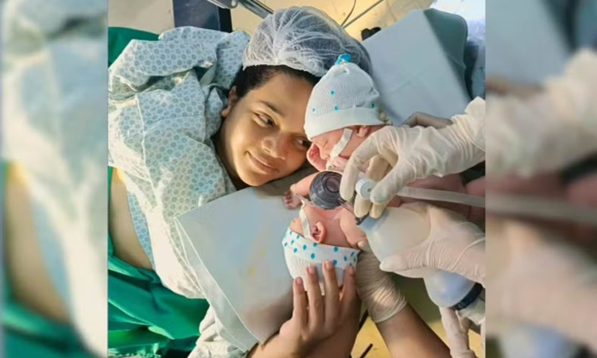 Conjoined twin dies days after birth during emergency separation ...